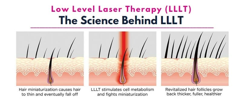 Stop Hair Loss in Its Tracks: How Low-Level Laser Therapy is Changing ...